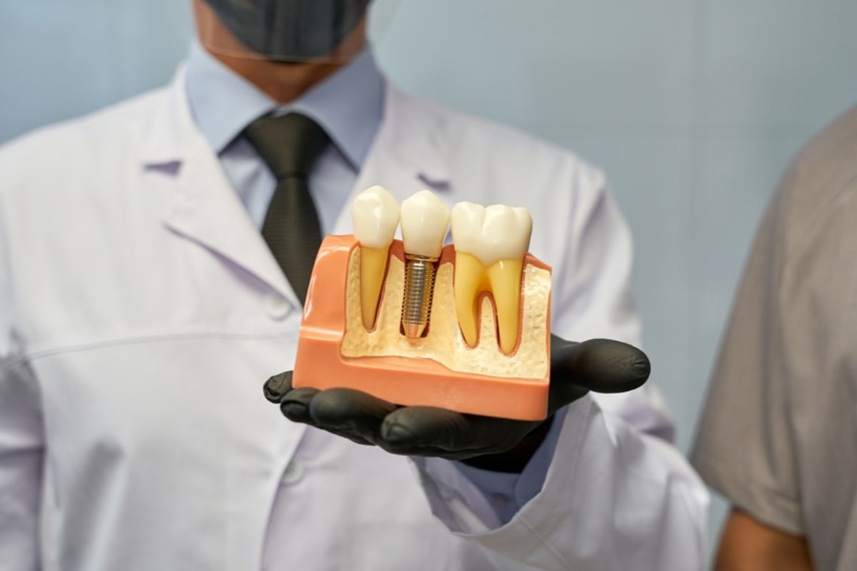 Are Dental Implants a Permanent Fix for Missing Teeth?